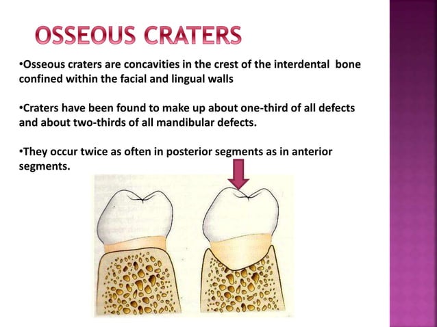 Patterns of bone destruction in periodontics | PPTX