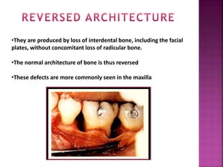 Patterns of bone destruction in periodontics | PPTX