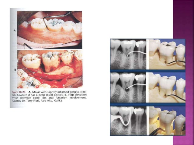Patterns of bone destruction in periodontics | PPTX