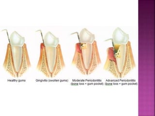 Patterns of bone destruction in periodontics | PPTX