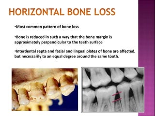 Patterns of bone destruction in periodontics | PPTX