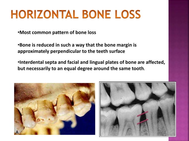 Patterns of bone destruction in periodontics | PPTX