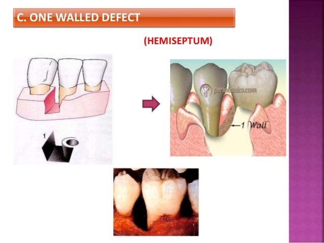 Patterns of bone destruction in periodontics