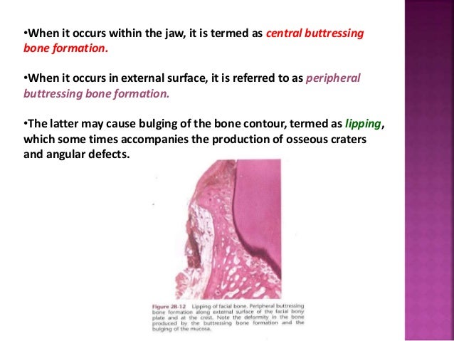 Patterns of bone destruction in periodontics