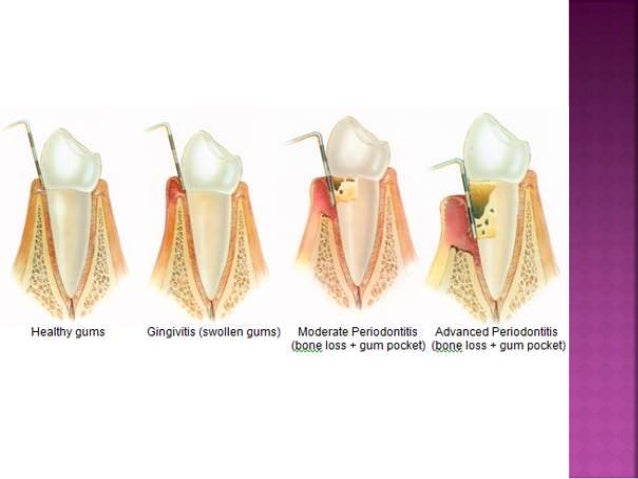 Patterns of bone destruction in periodontics