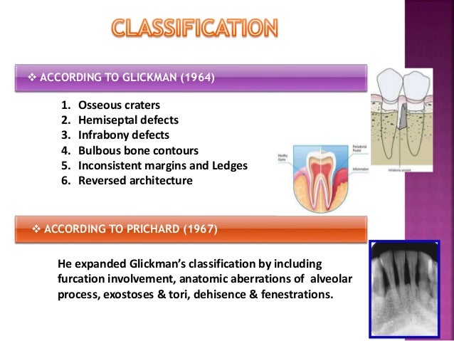 Patterns of bone destruction in periodontics