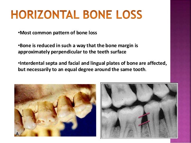 Patterns of bone destruction in periodontics