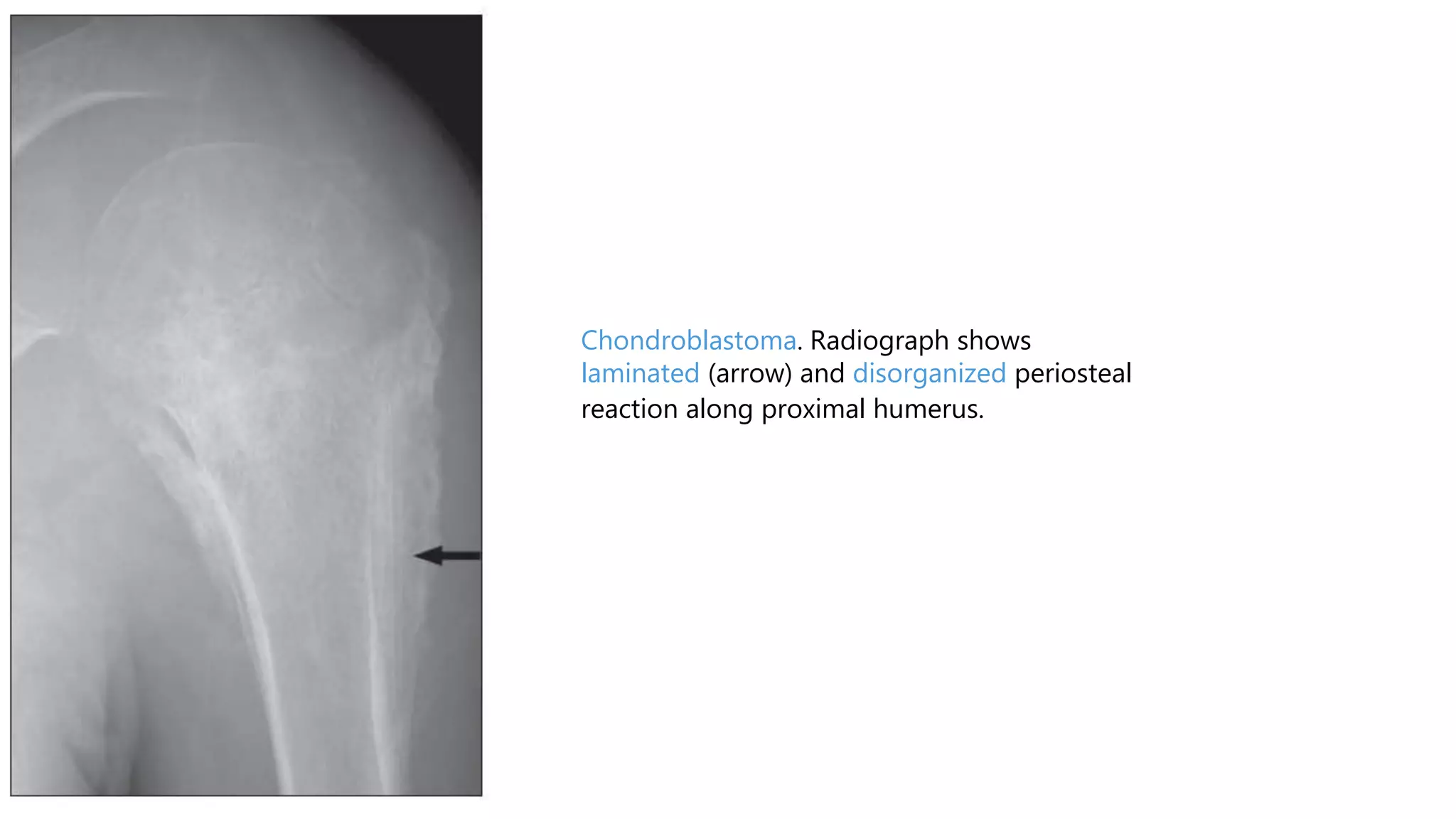 Periosteal reaction | PPTX