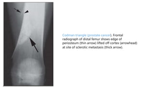 Periosteal reaction | PPTX