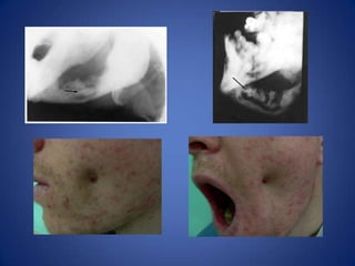 Periostitis | PPTX