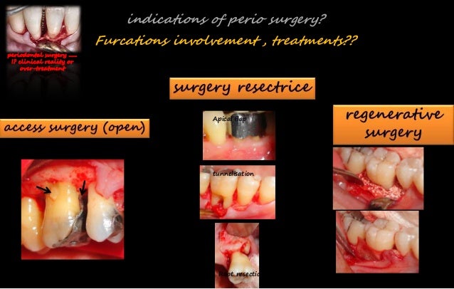 Perio surgery