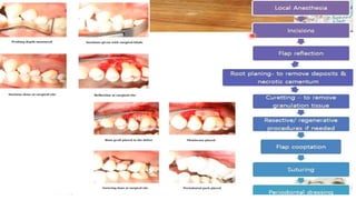 perio surgery.pptx