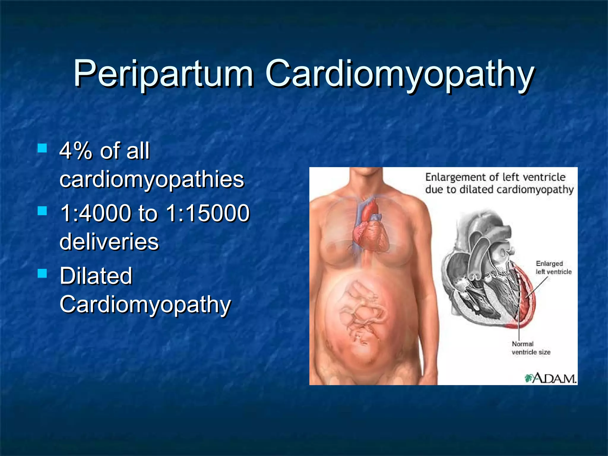 Peripartum Cardiomyopathy | PPT
