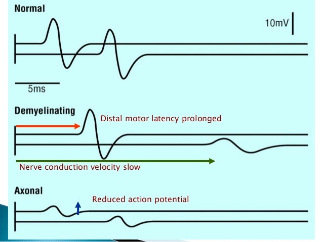Peripheral neuropathy