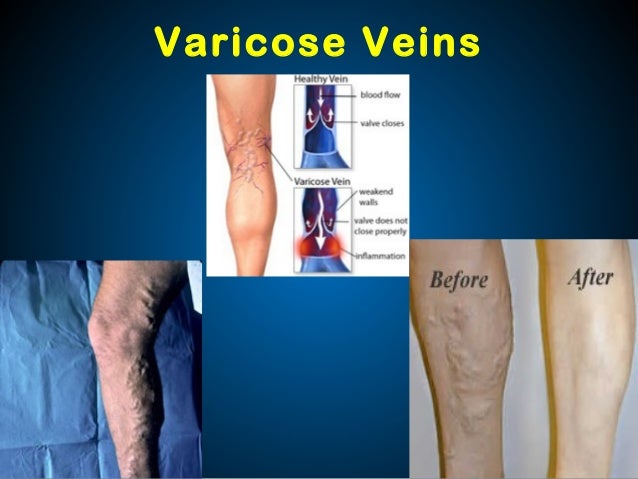 Venous Disease: Peripheral and Embolic