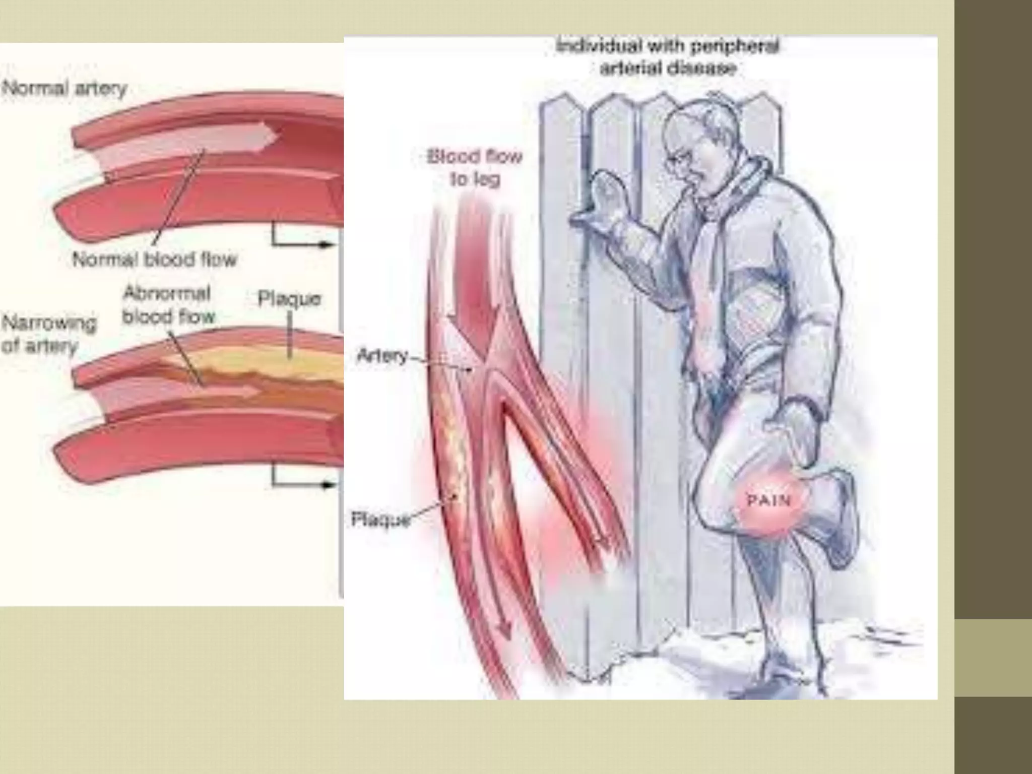 Peripheral angiography | PPTX