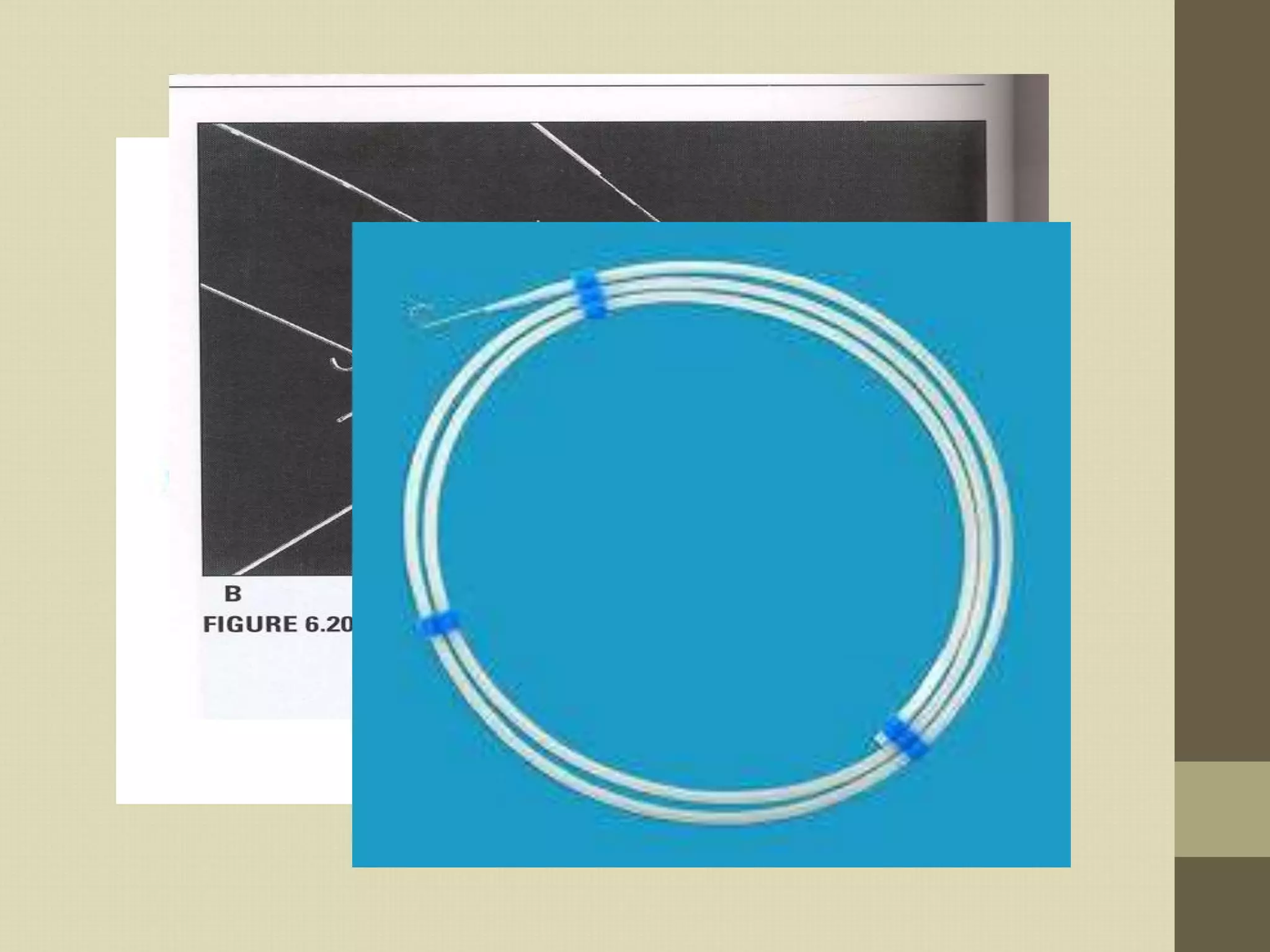 Peripheral angiography | PPTX