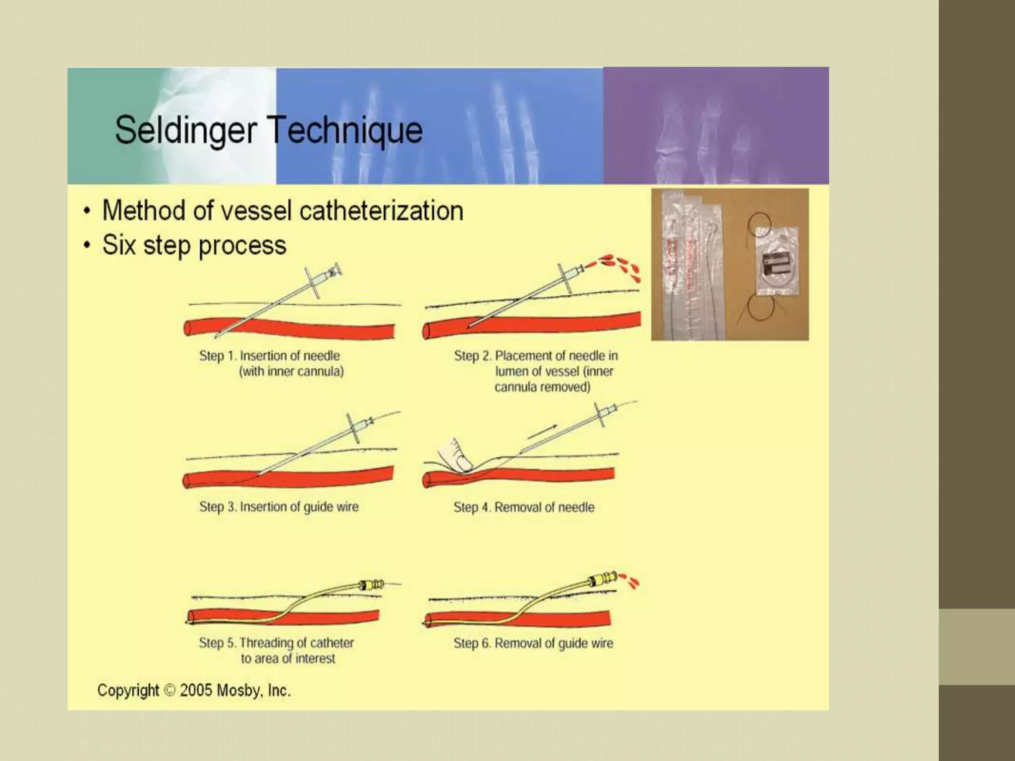 Peripheral angiography | PPTX