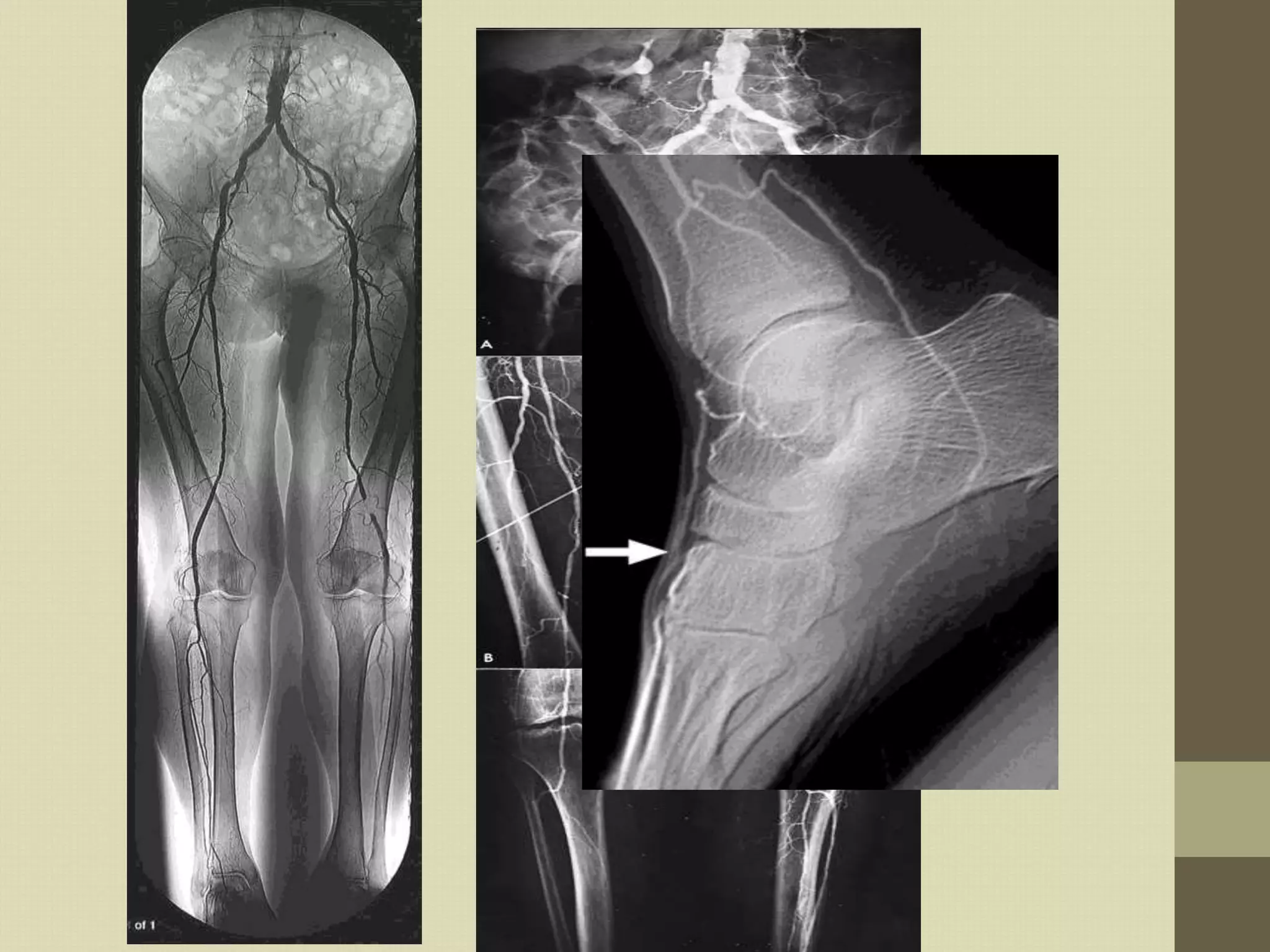 Peripheral angiography | PPTX