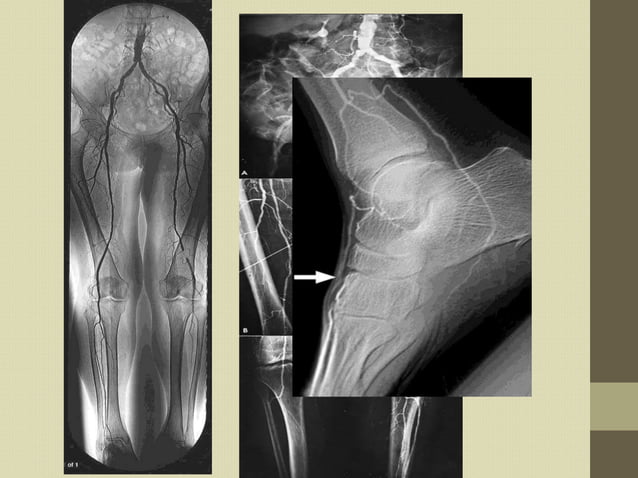 Peripheral angiography | PPTX