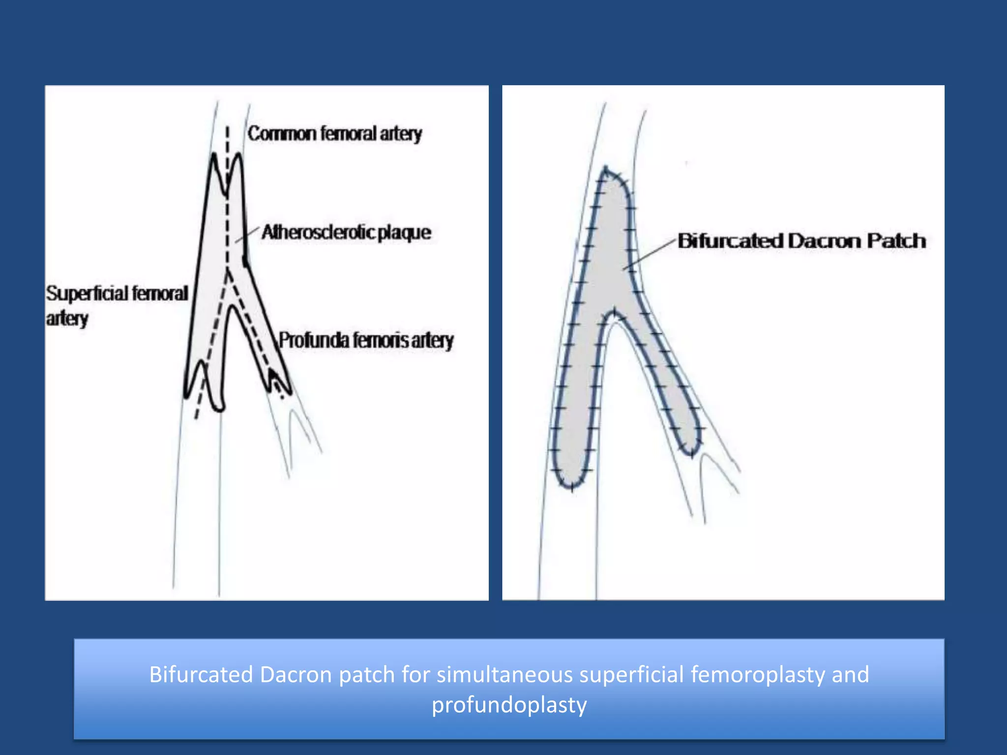 CHRONIC PERIPHERAL ARTERIAL OCCLUSIVE DISEASE | PPTX