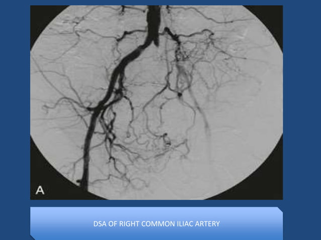 CHRONIC PERIPHERAL ARTERIAL OCCLUSIVE DISEASE | PPTX