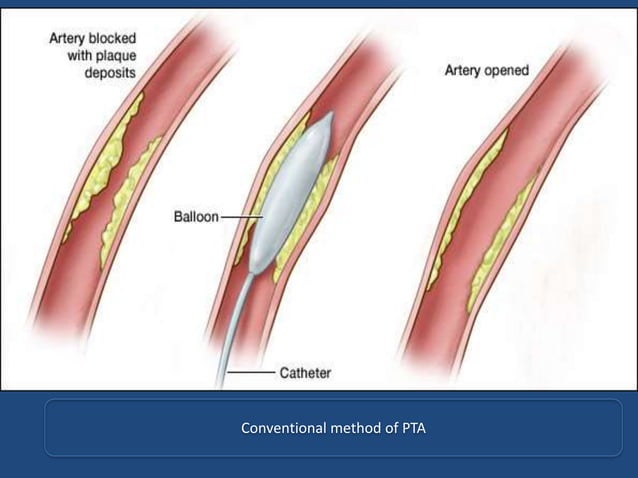 CHRONIC PERIPHERAL ARTERIAL OCCLUSIVE DISEASE | PPTX