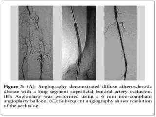 CHRONIC PERIPHERAL ARTERIAL OCCLUSIVE DISEASE | PPTX