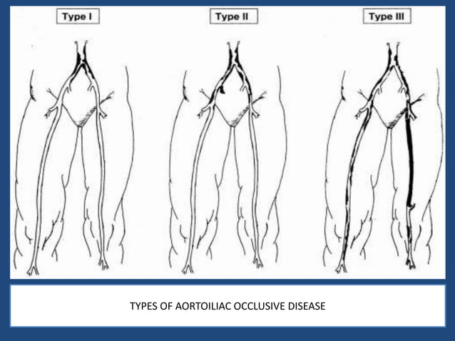 CHRONIC PERIPHERAL ARTERIAL OCCLUSIVE DISEASE | PPTX