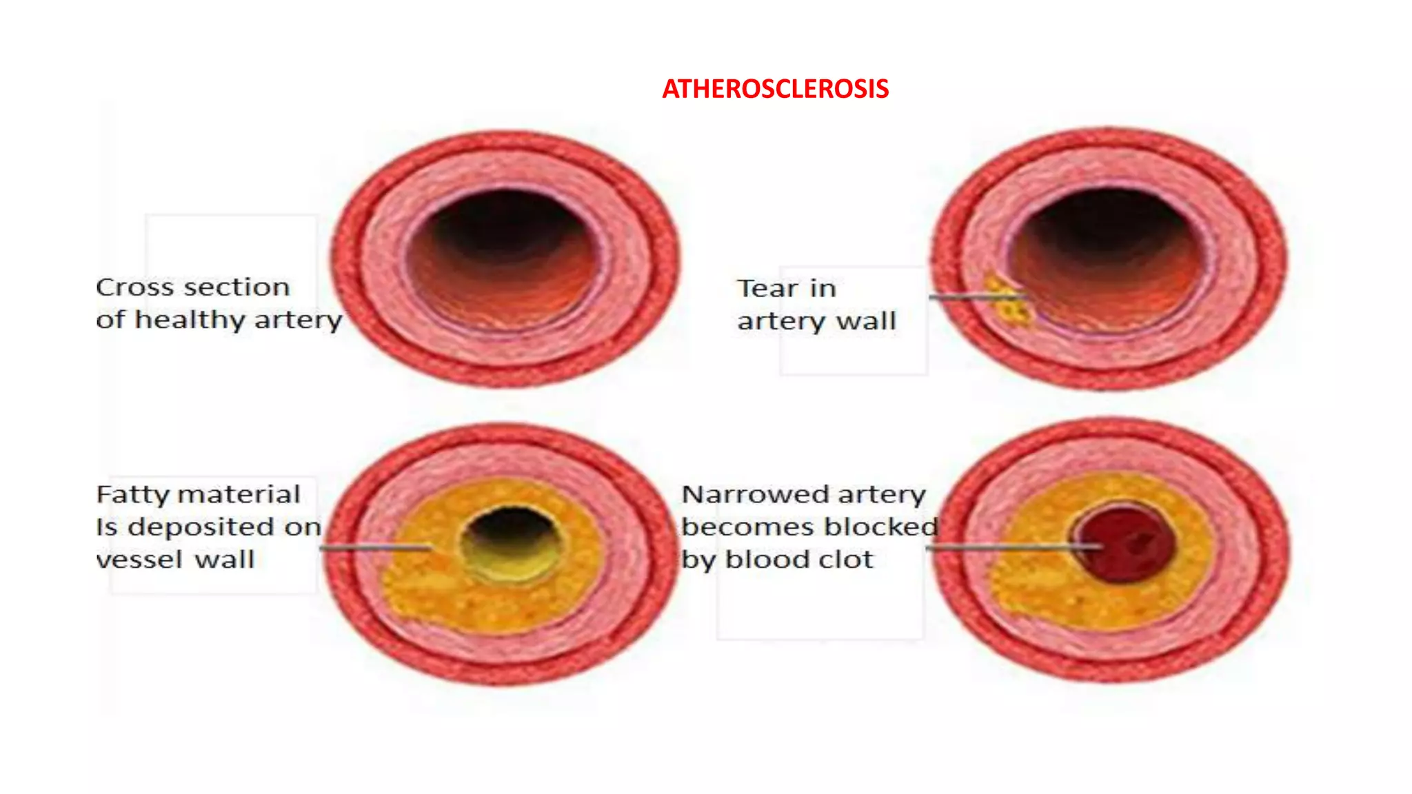 Peripheral Arterial Disease Pptx