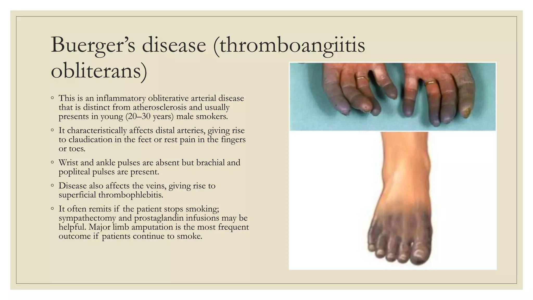 Peripheral Arterial Disease.pptx