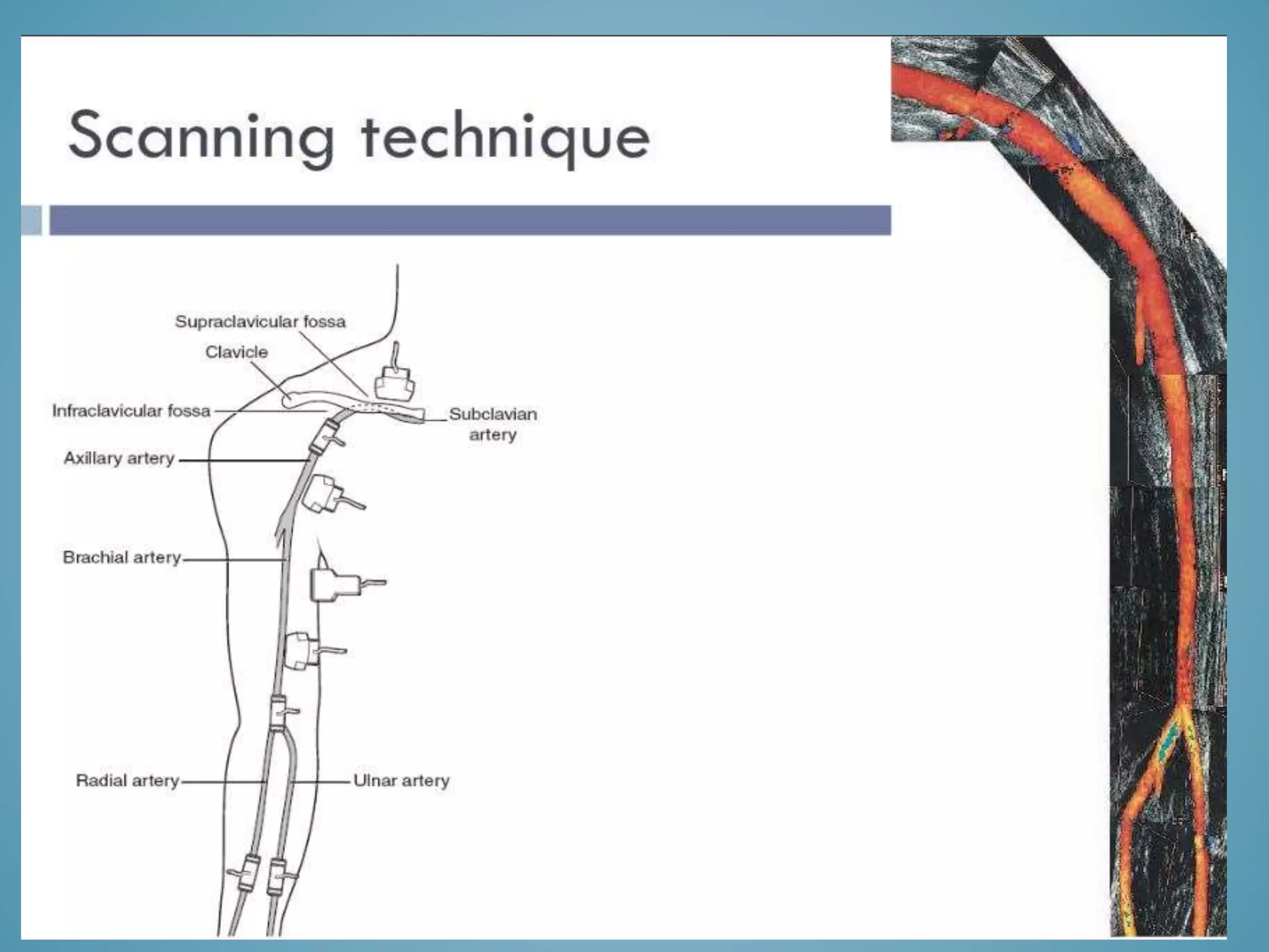 Peripheral arterial doppler | PPTX