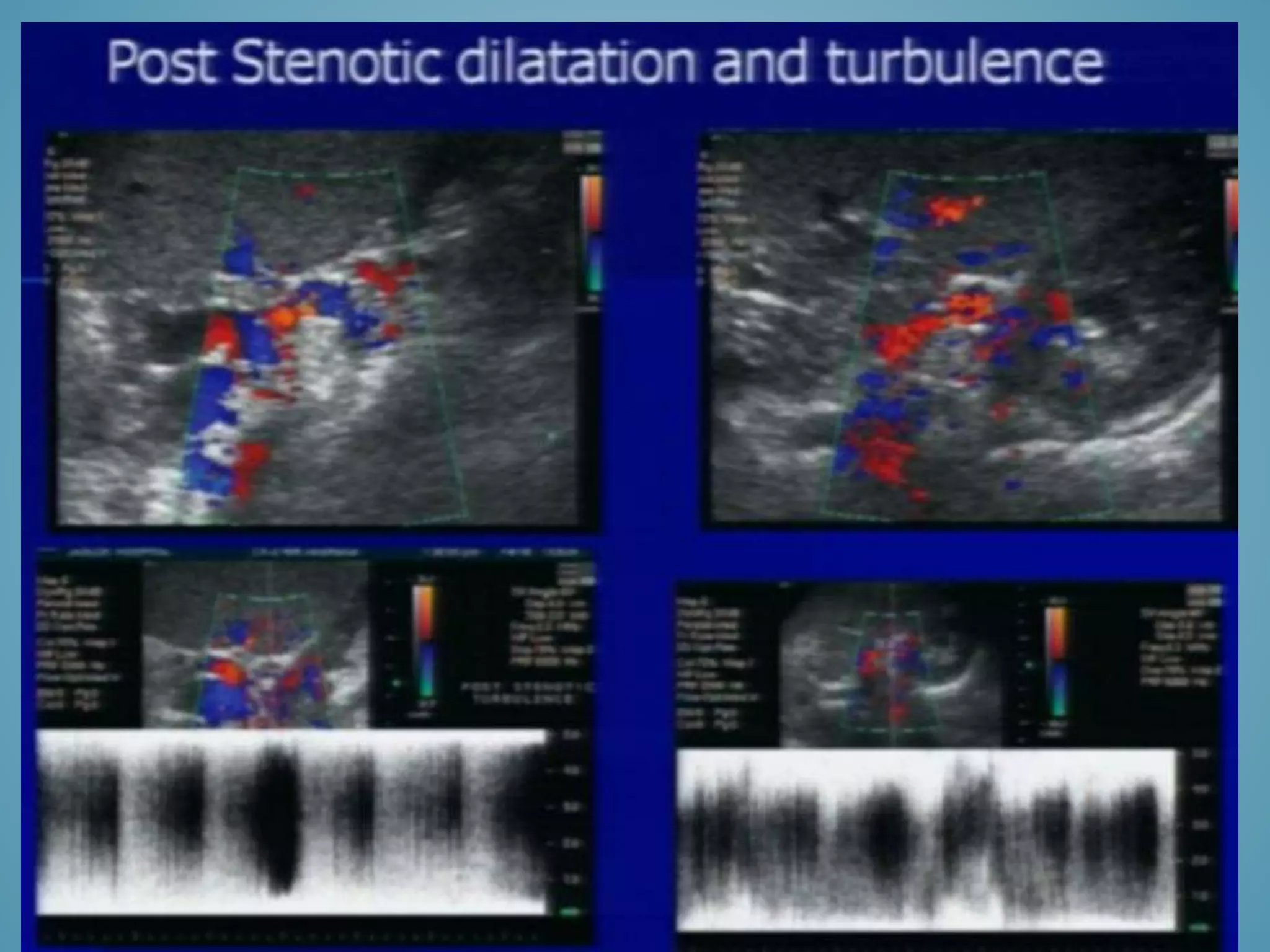 Peripheral arterial doppler | PPTX