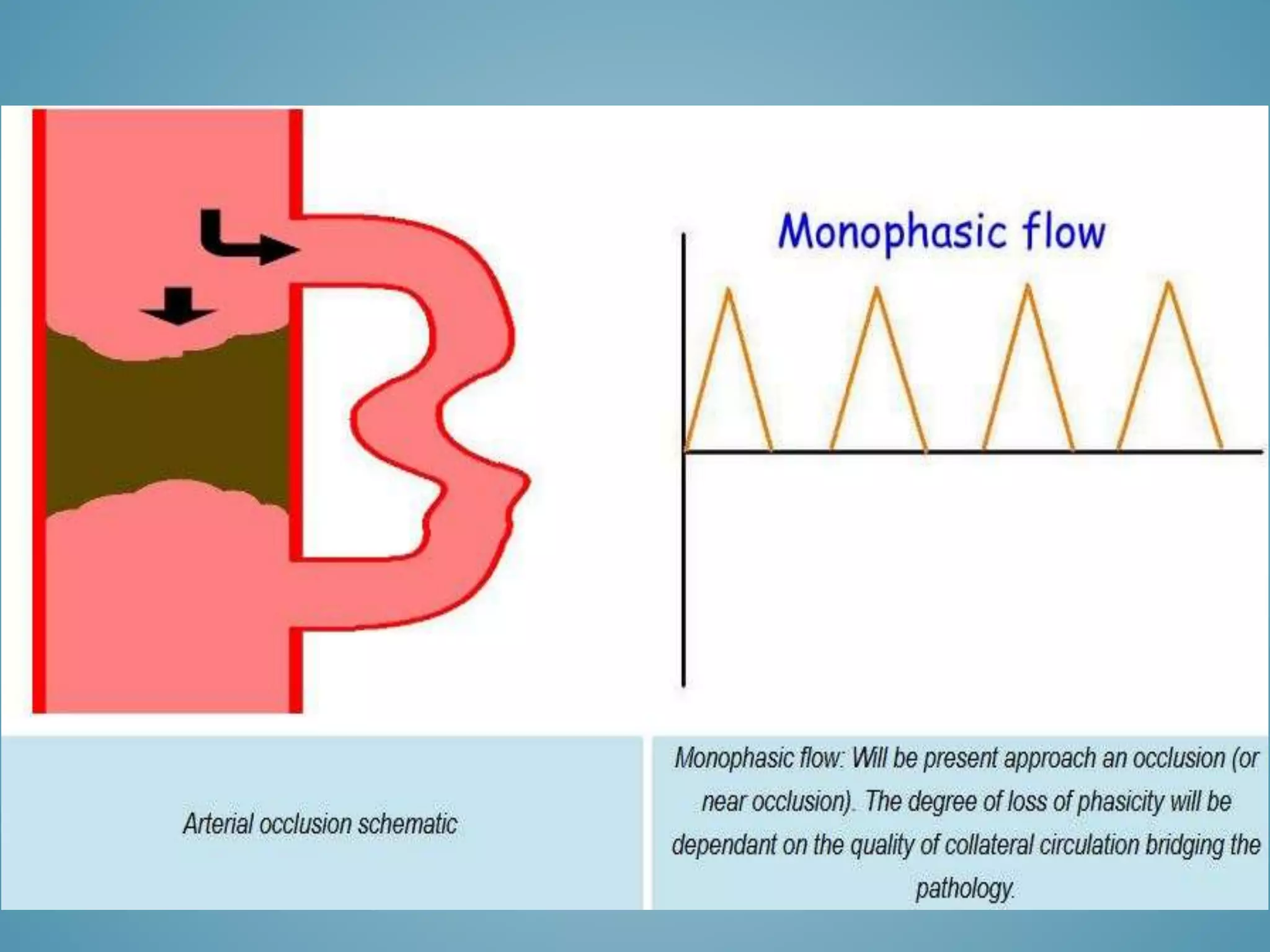 Peripheral arterial doppler | PPTX