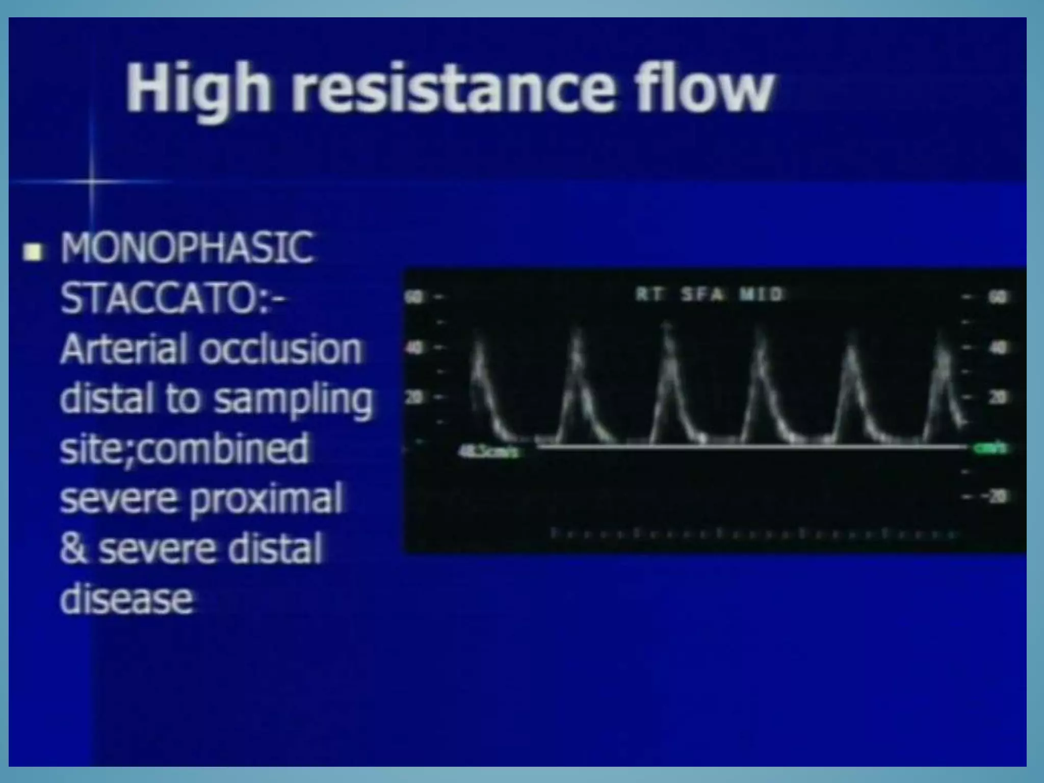 Peripheral arterial doppler | PPTX