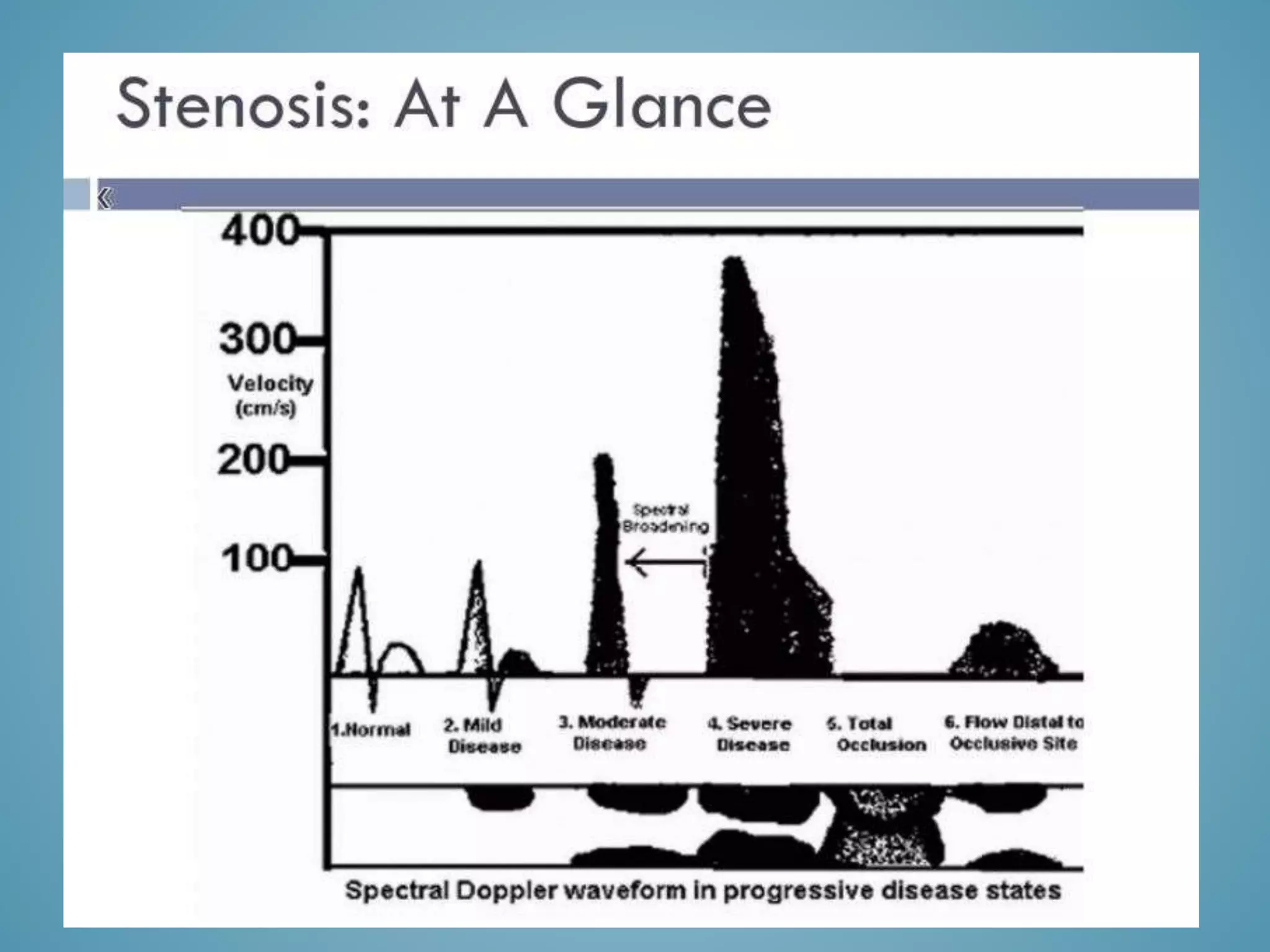 Peripheral arterial doppler | PPTX