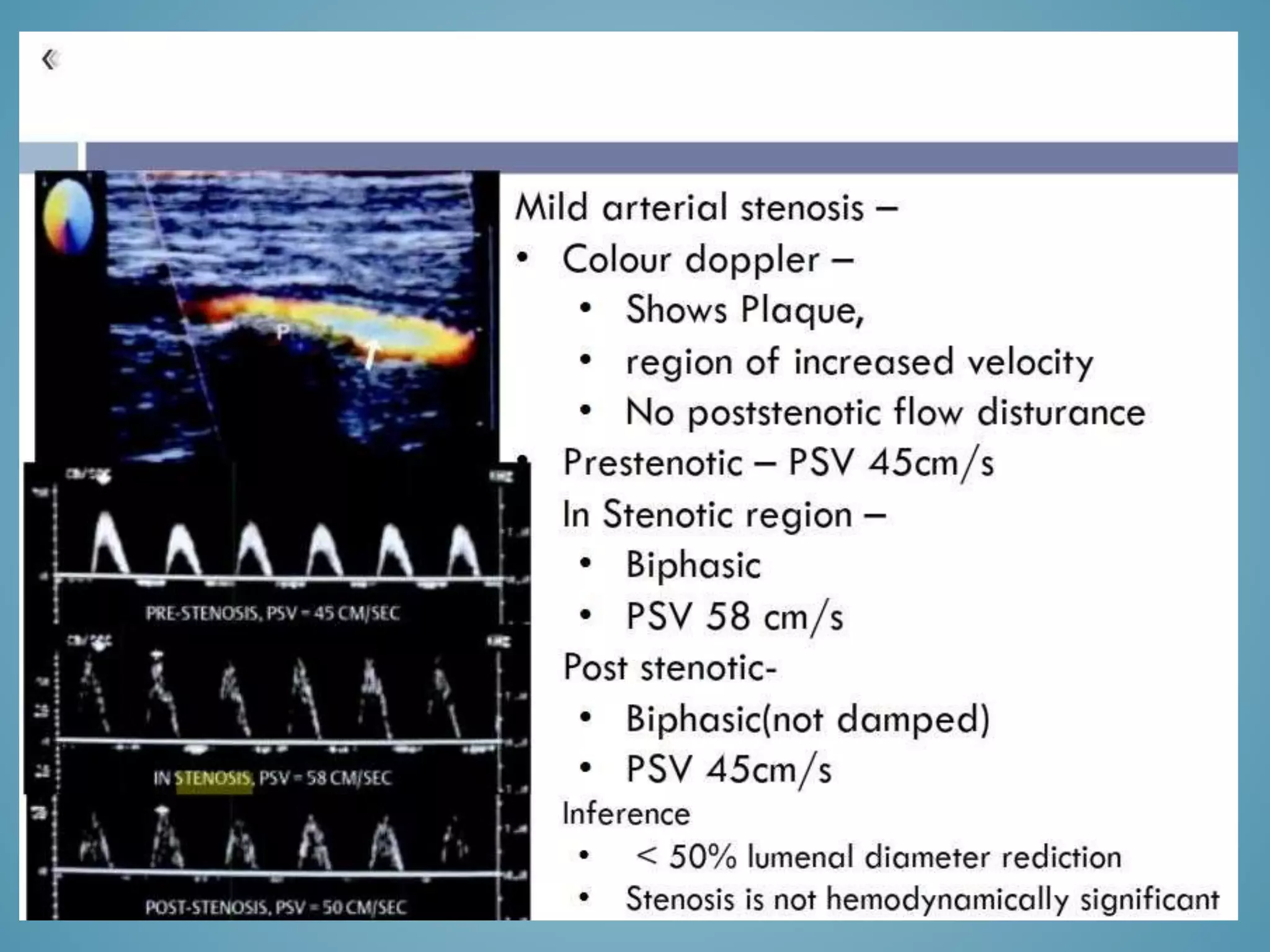 Peripheral arterial doppler | PPTX