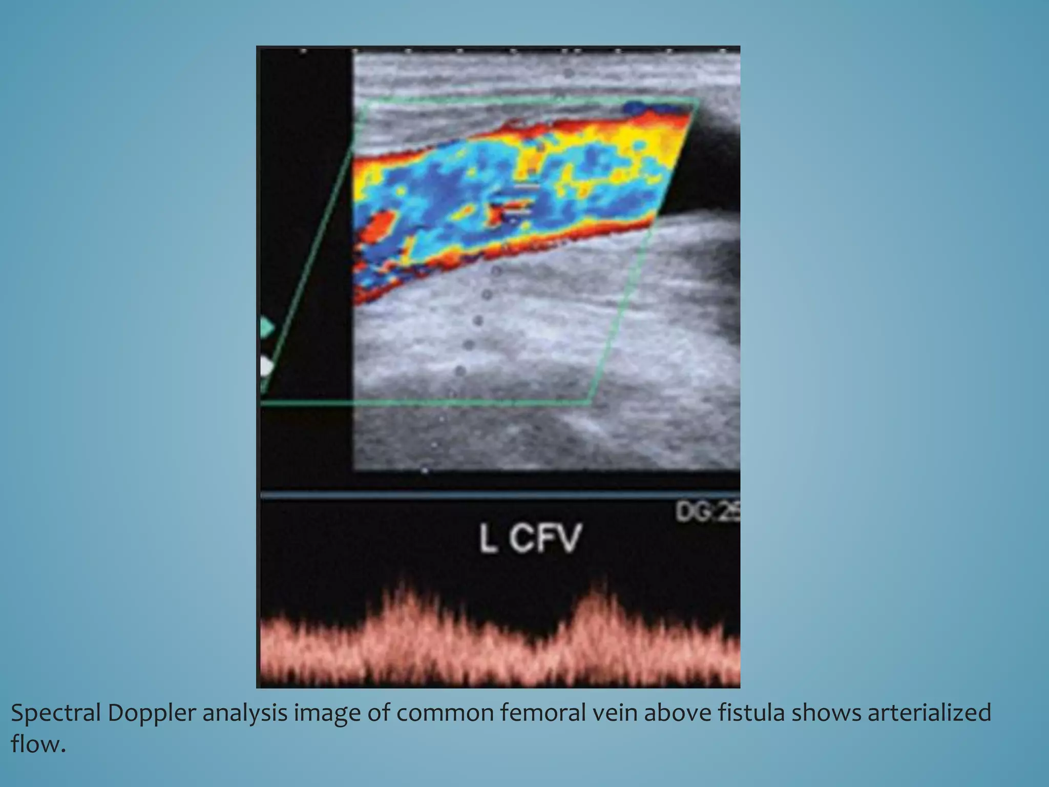 Peripheral arterial doppler | PPTX