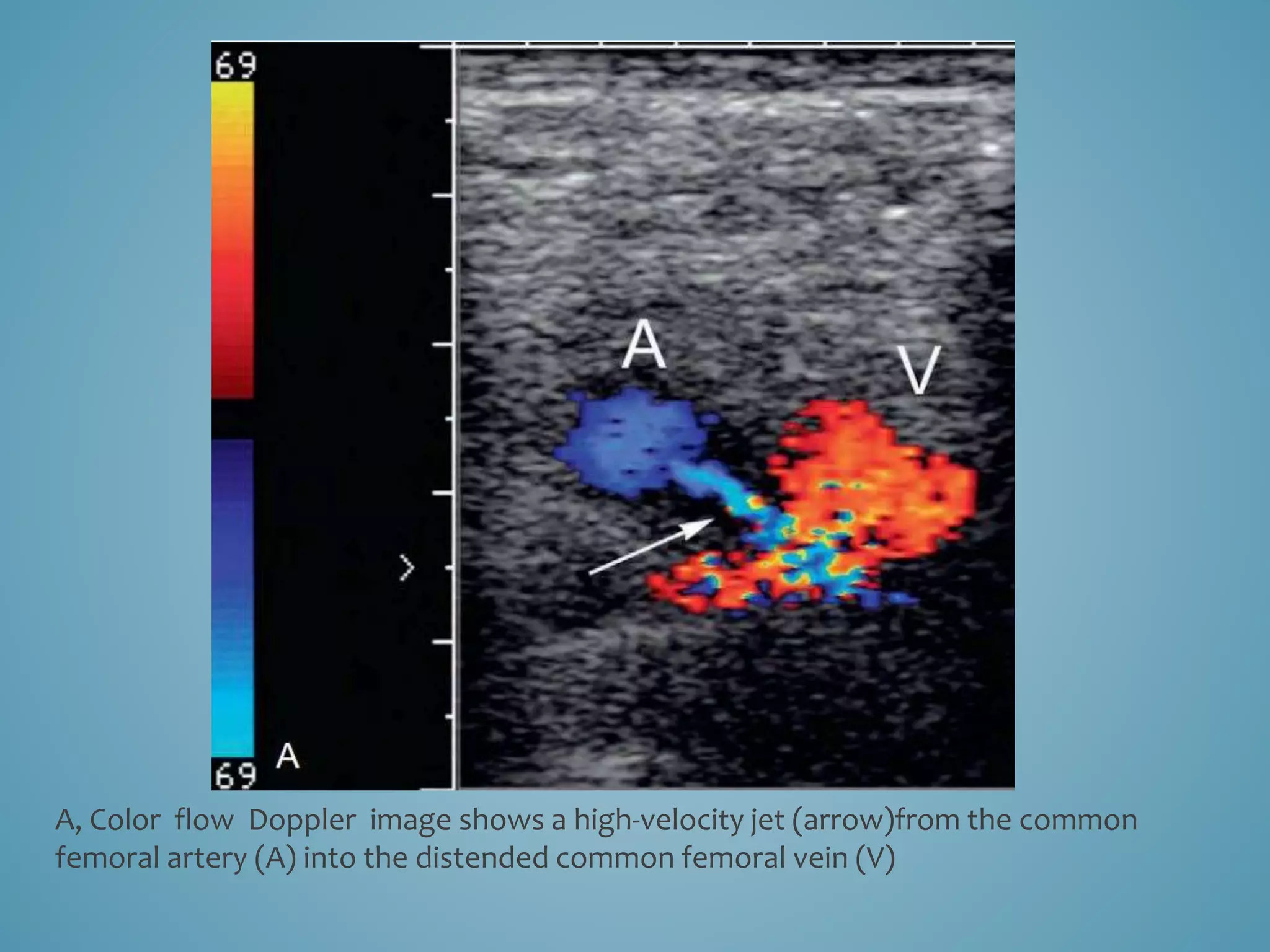 Peripheral arterial doppler | PPTX