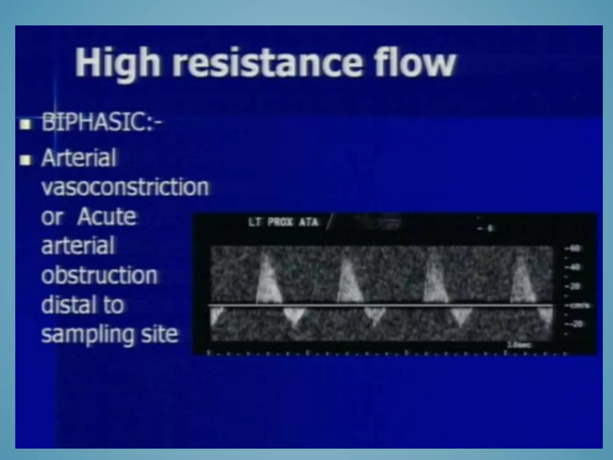 Peripheral arterial doppler | PPTX