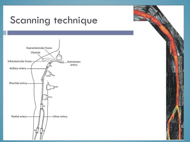 Peripheral arterial doppler | PPTX | Blood Disorders | Diseases and ...