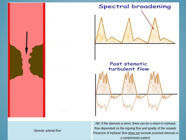 Peripheral arterial doppler | PPTX | Blood Disorders | Diseases and ...