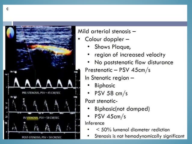 Peripheral arterial doppler | PPT