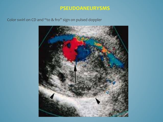 Peripheral arterial doppler | PPTX | Blood Disorders | Diseases and ...