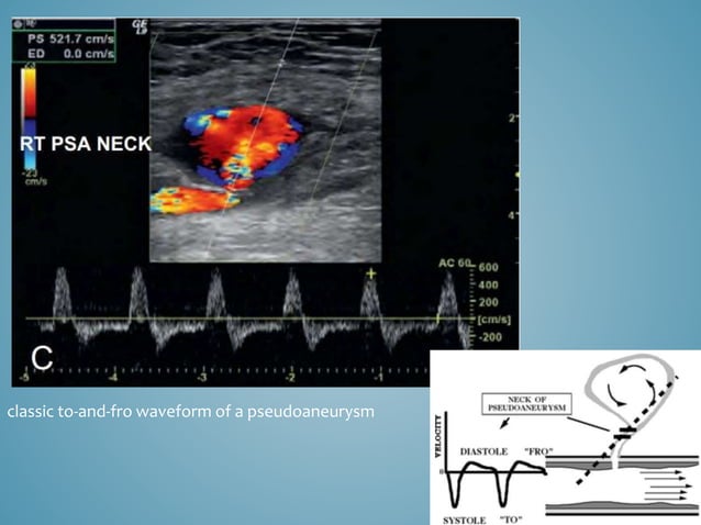 Peripheral arterial doppler | PPTX | Blood Disorders | Diseases and ...