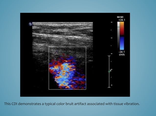 Peripheral arterial doppler | PPTX | Blood Disorders | Diseases and ...