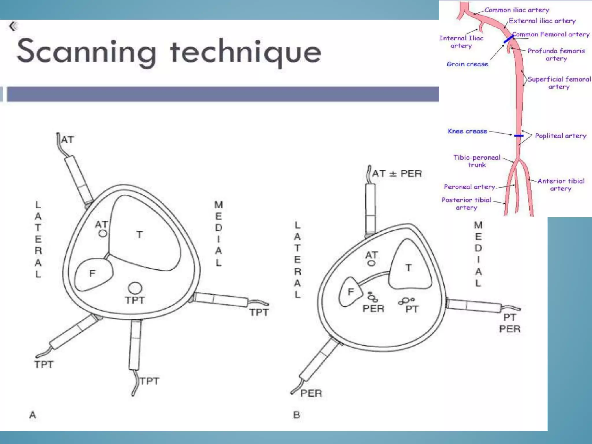 Peripheral arterial doppler | PPTX