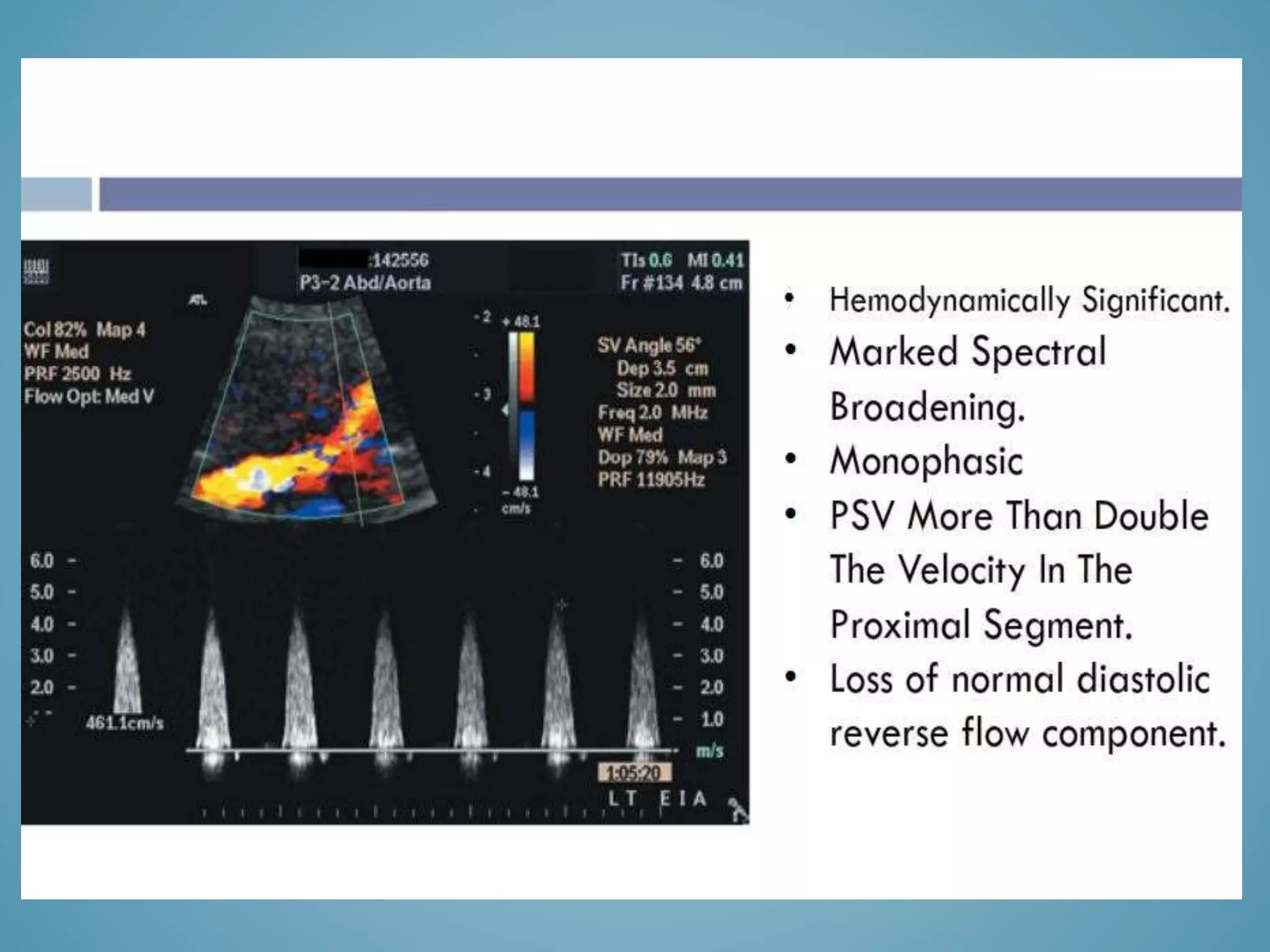 Peripheral arterial doppler | PPTX
