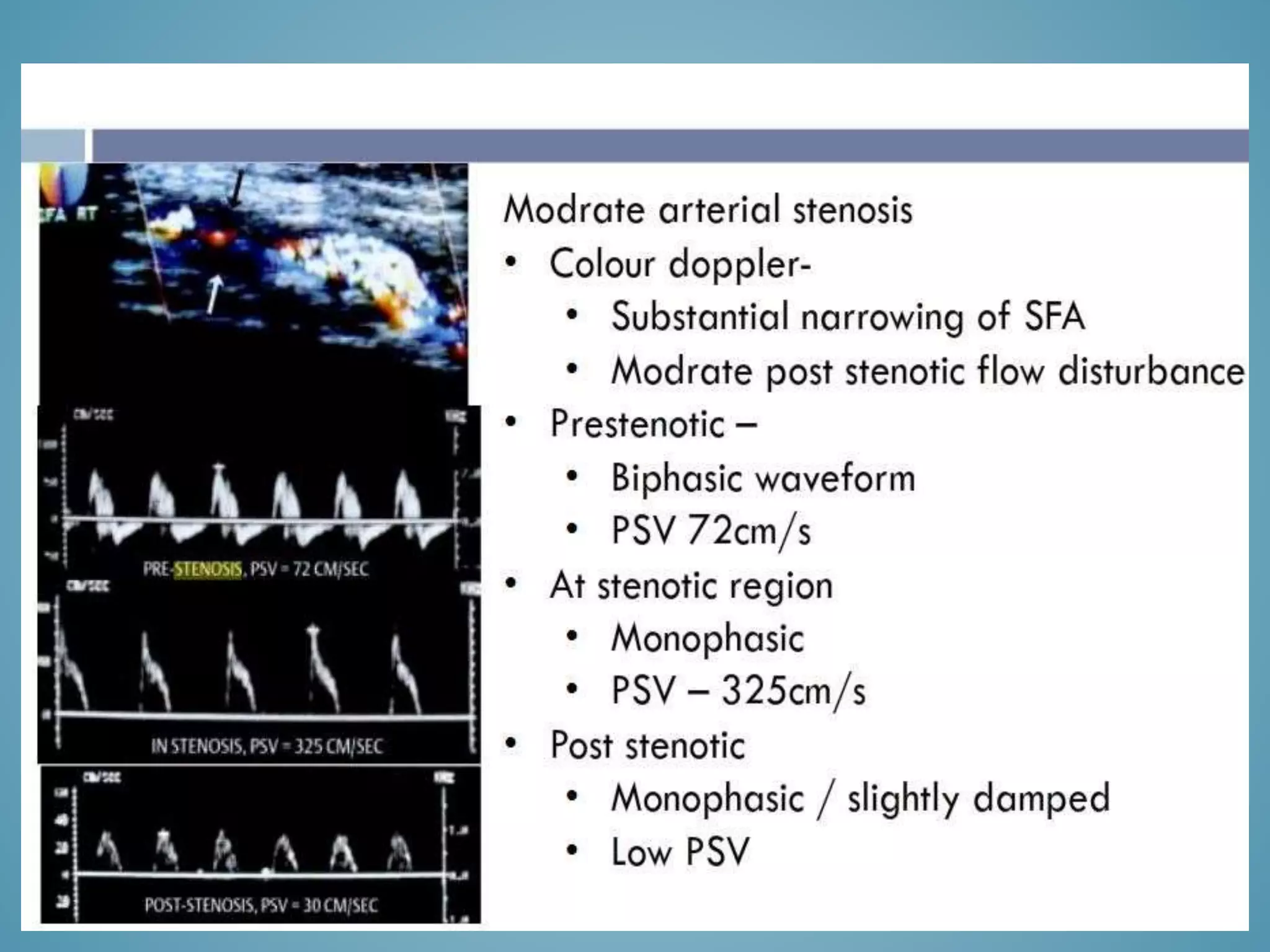 Peripheral arterial doppler | PPT
