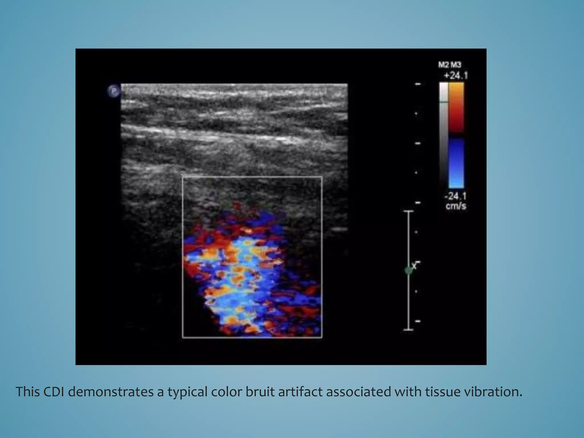 Peripheral arterial doppler | PPT